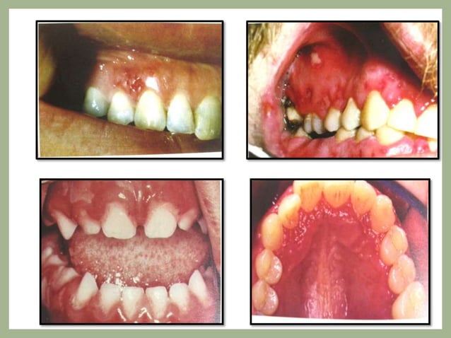 acute gingival infections- symptoms, treatment | PPTX