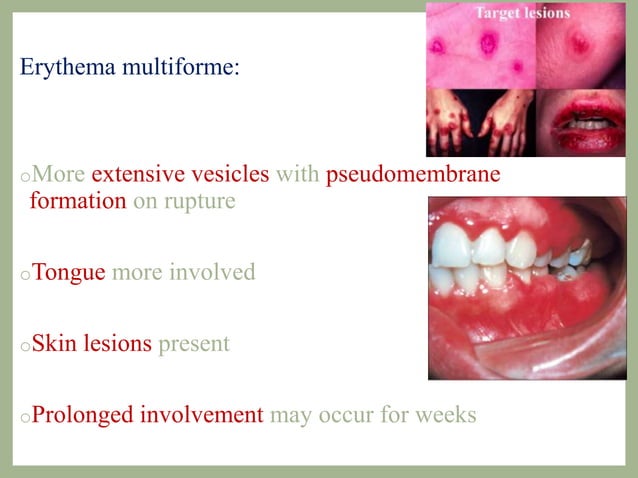 acute gingival infections- symptoms, treatment | PPTX