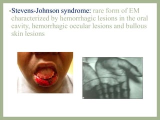 acute gingival infections- symptoms, treatment | PPTX
