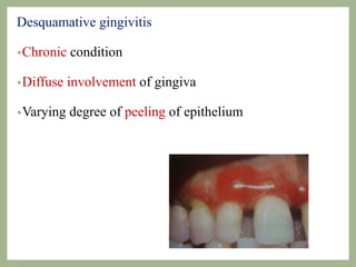 acute gingival infections- symptoms, treatment | PPTX