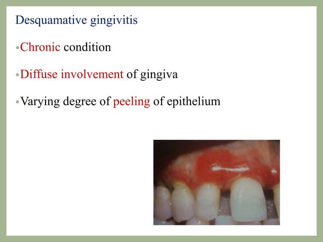 acute gingival infections- symptoms, treatment | PPTX