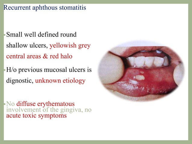 acute gingival infections- symptoms, treatment | PPTX
