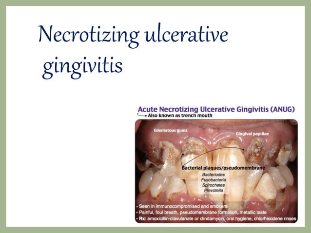 acute gingival infections- symptoms, treatment | PPTX