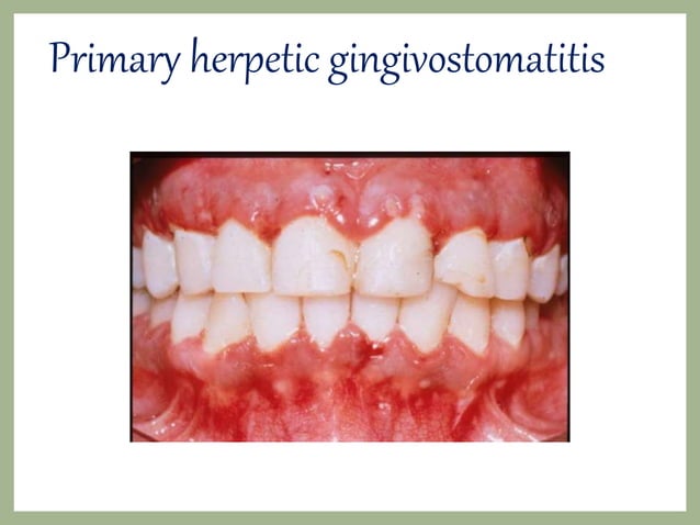 acute gingival infections- symptoms, treatment | PPTX