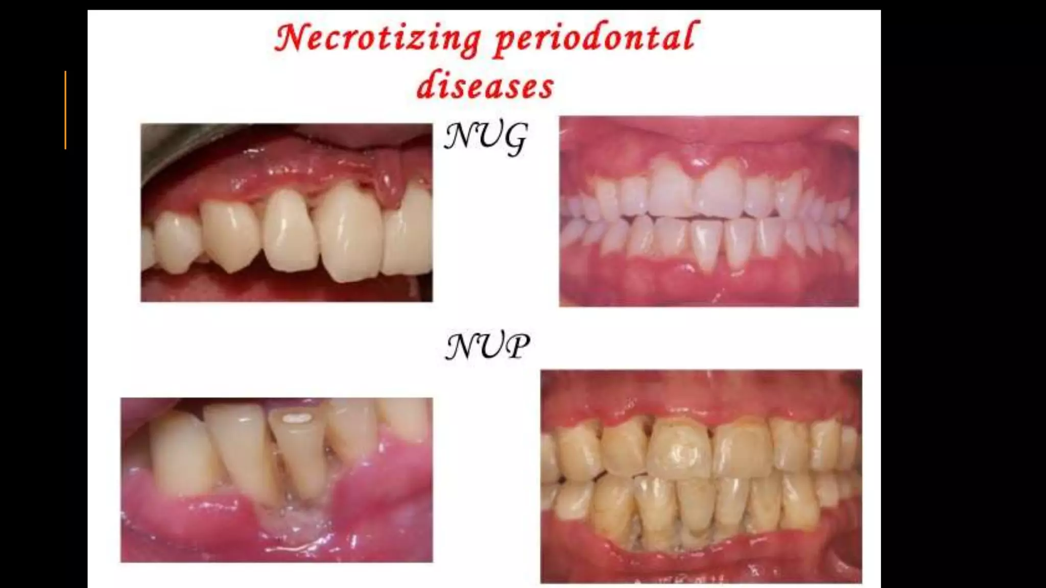 Acute gingival infections and desquamative gingivitis | PPT