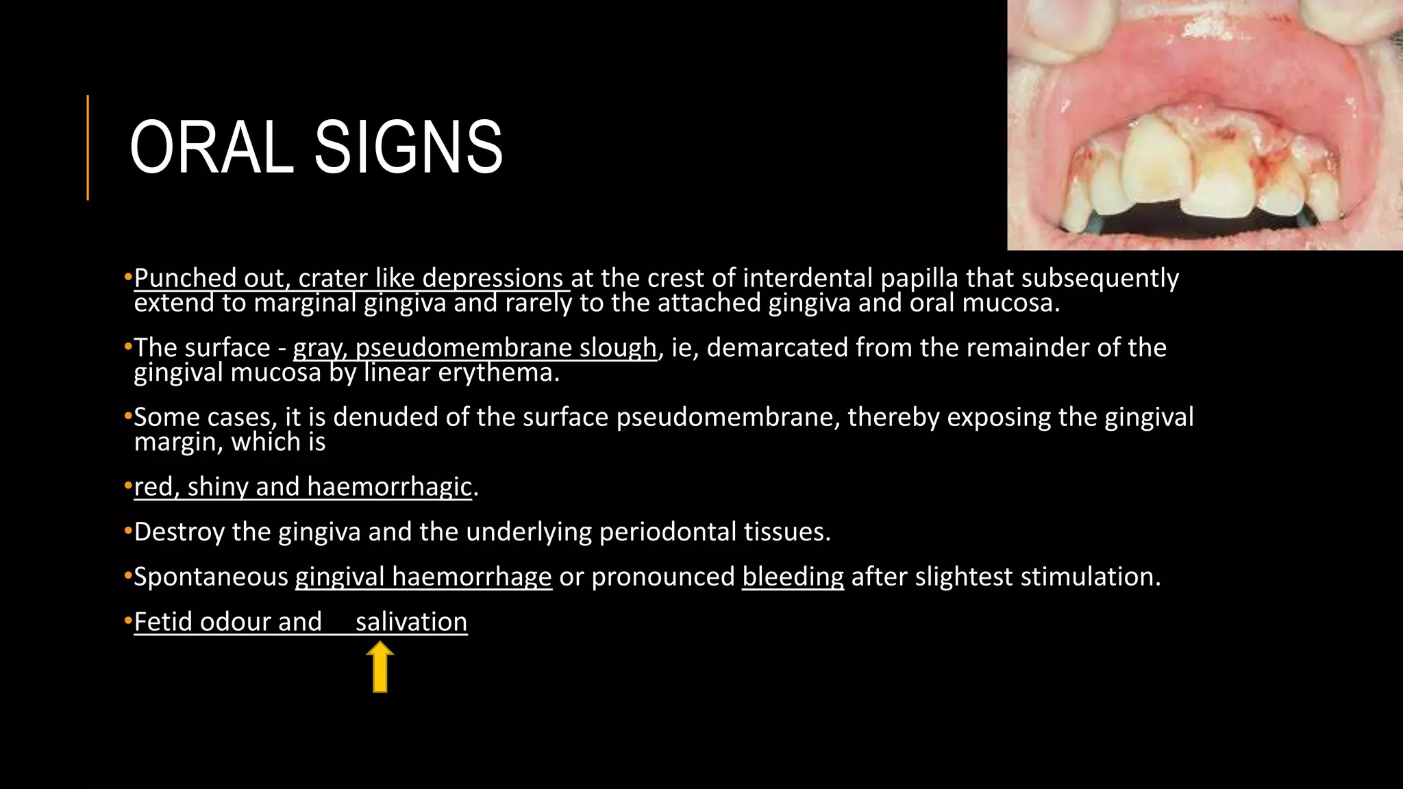 Acute gingival infections and desquamative gingivitis | PPT