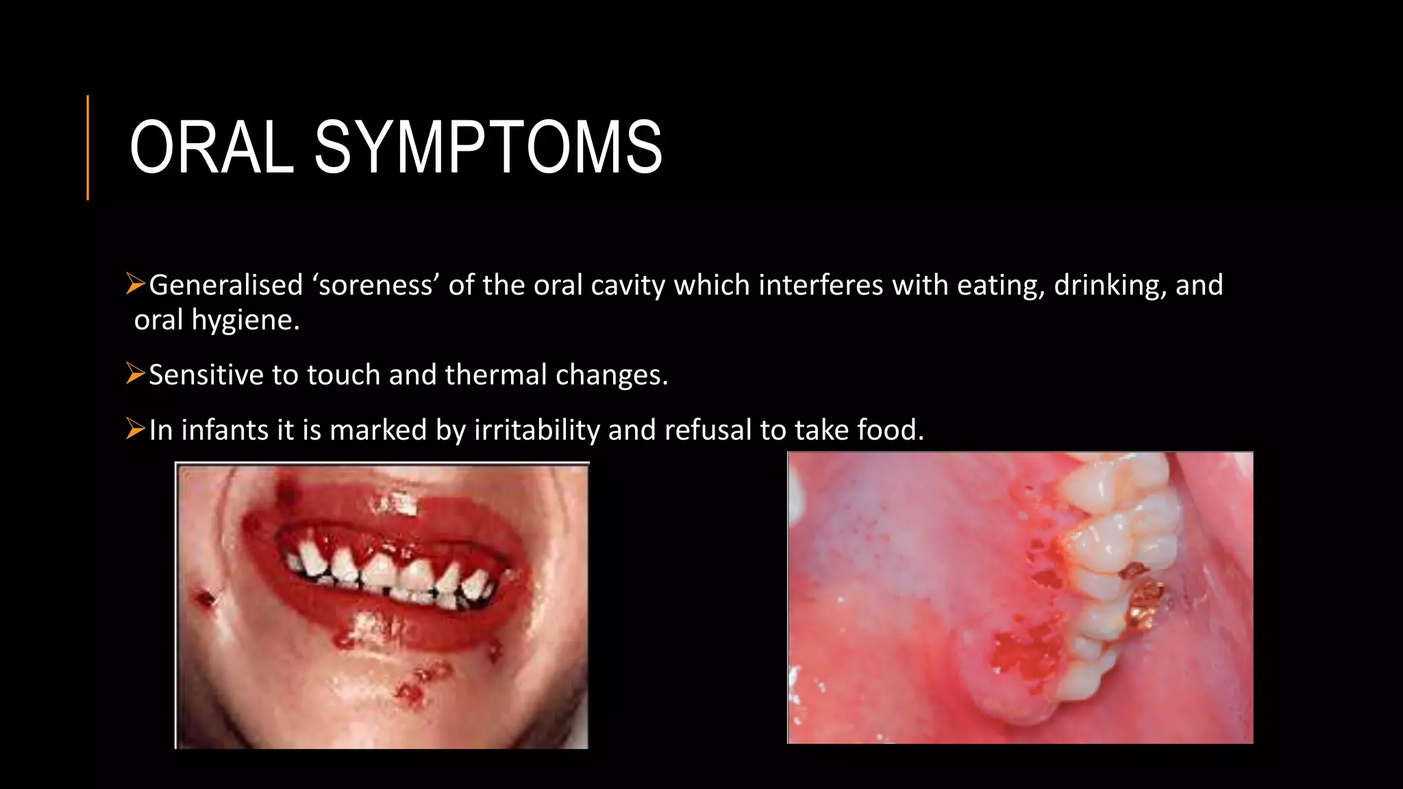 Acute gingival infections and desquamative gingivitis | PPT