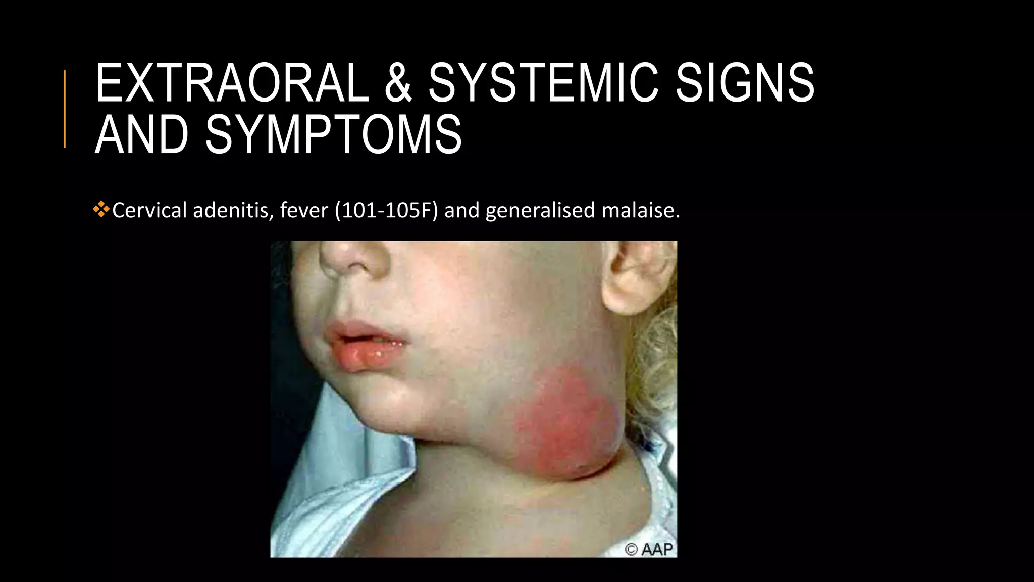 Acute gingival infections and desquamative gingivitis | PPT