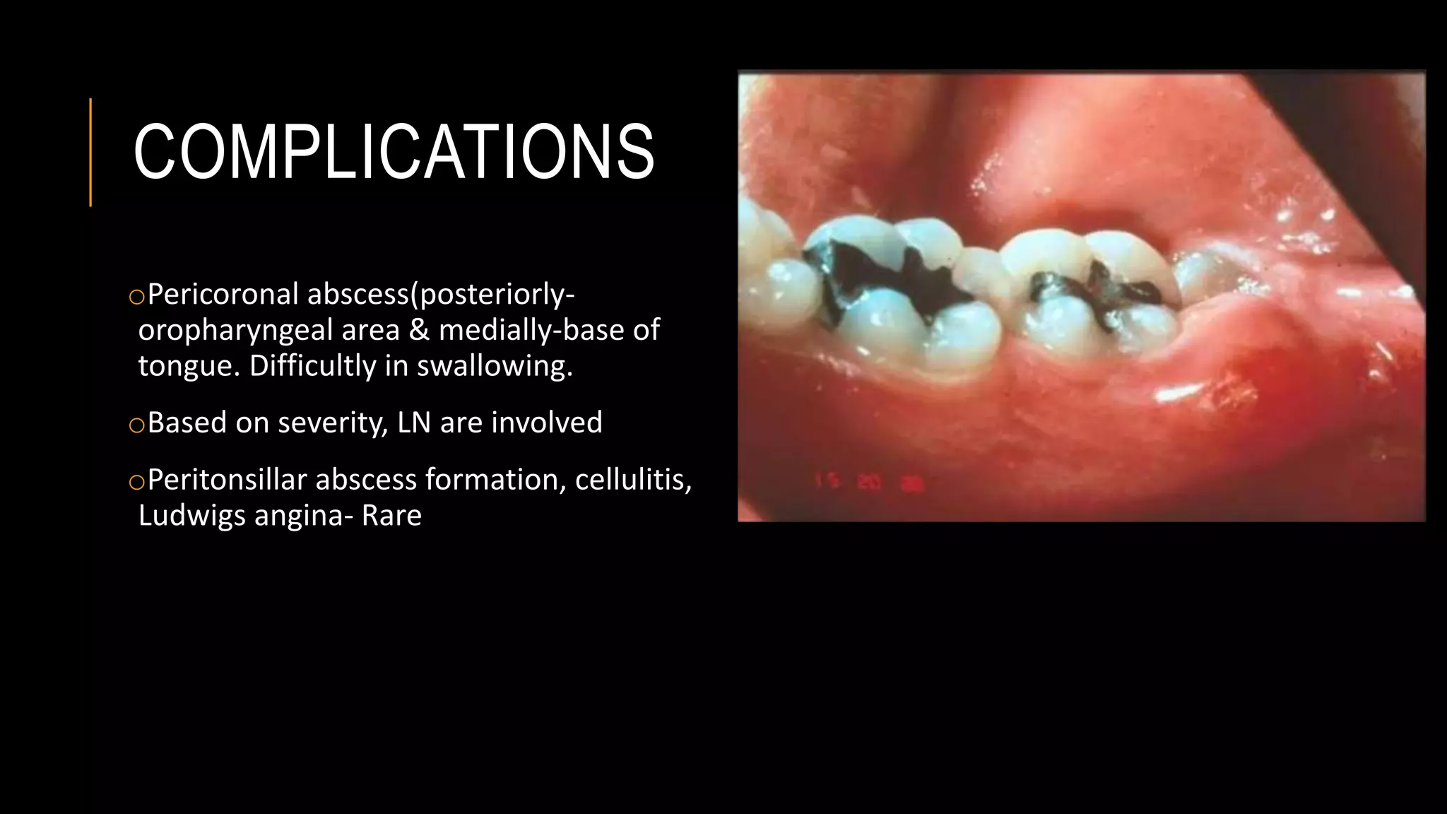 Acute gingival infections and desquamative gingivitis | PPT