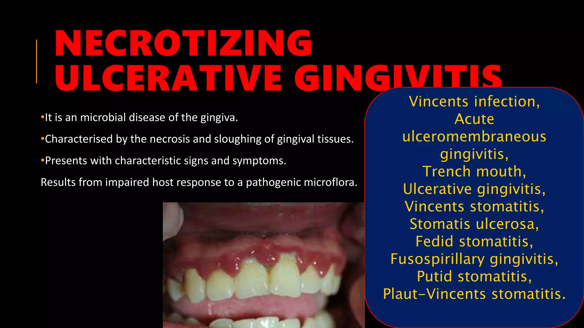 Acute gingival infections and desquamative gingivitis | PPT