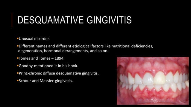 Acute gingival infections and desquamative gingivitis | PPT