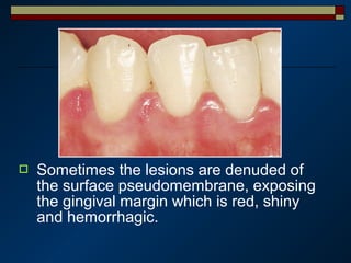Acute gingival infrections | PPT