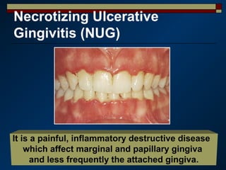 Acute Necrotizing Ulcerative Gingivitis