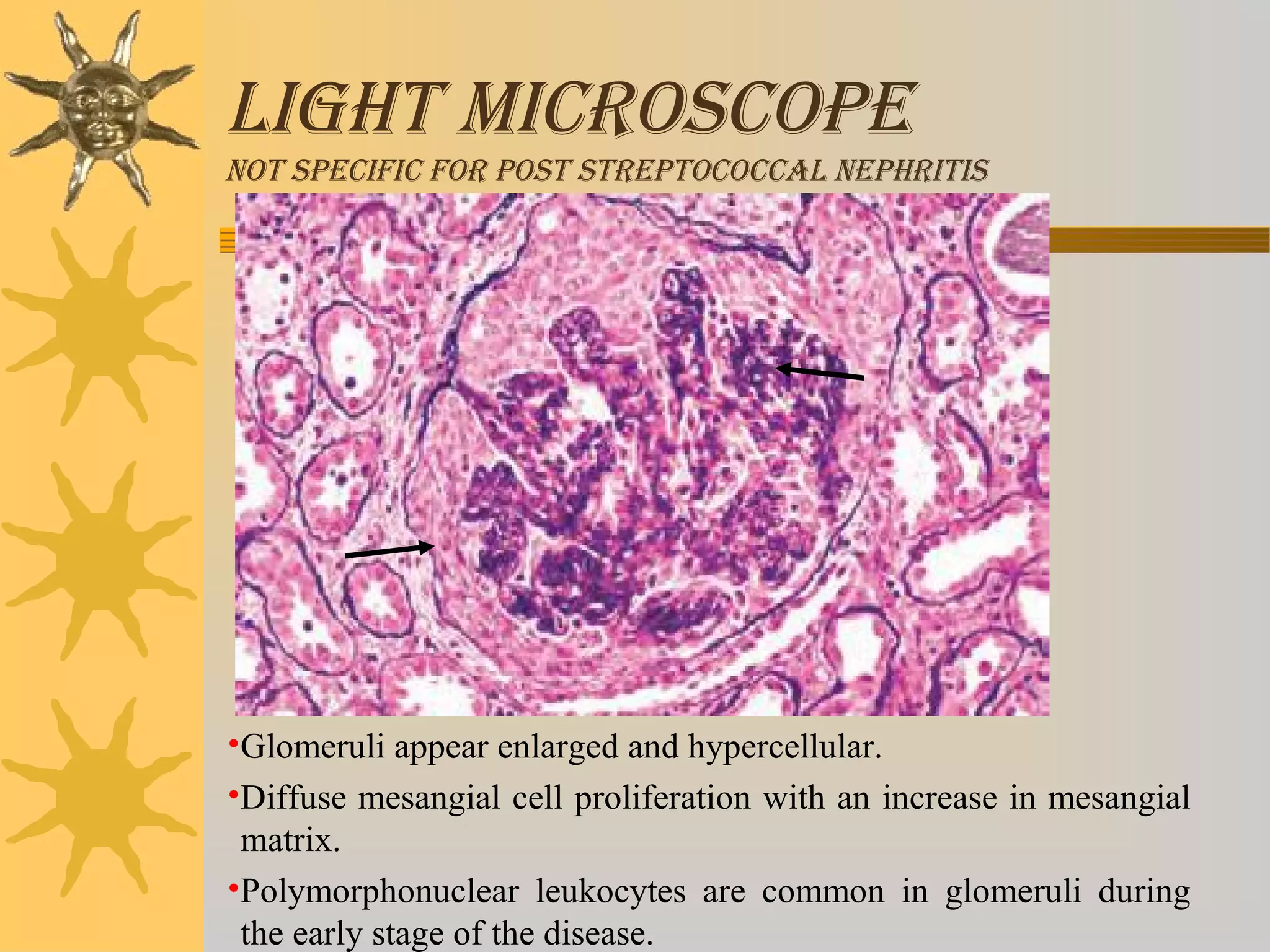 Acute glomerular disease | PPT