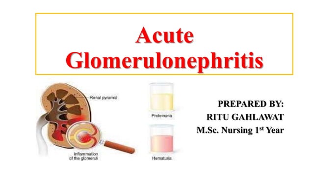 acute glomerulonephritis in pediatrics by ritu gahlawat | PPTX | Blood ...