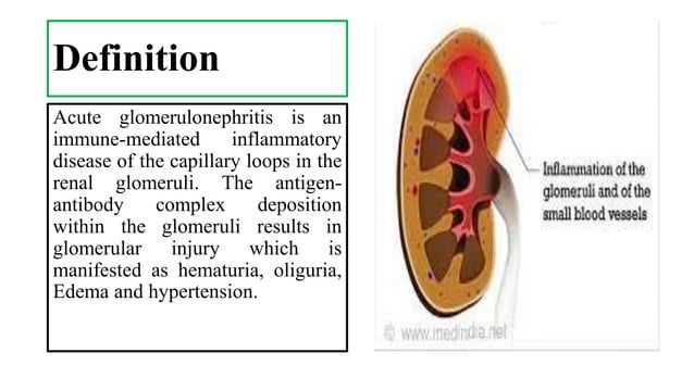 acute glomerulonephritis in pediatrics by ritu gahlawat | PPTX | Blood ...