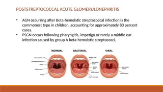 ACUTE GLOMERULONEPHRITIS in children.pptx