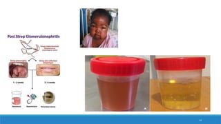 Acute Glomerulonephritis, Bergers disease, Lupus Nephritis, Post strep ...