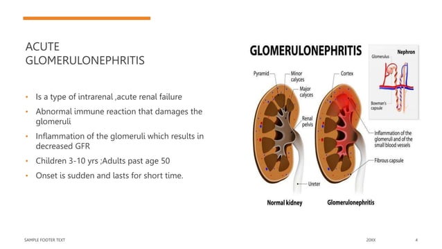 Acute glomerulonephritis and nephrotic syndrome.pptx
