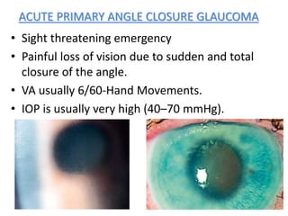 Acute glucoma.pptx