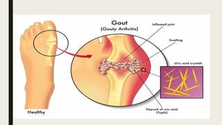 Acute Gout Pathophysiology and Management | PPTX