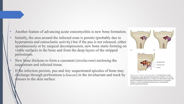ACUTE HAEMATOGENOUS OSTEOMYELITIS- emergency orthopaedics.pptx | Bone ...