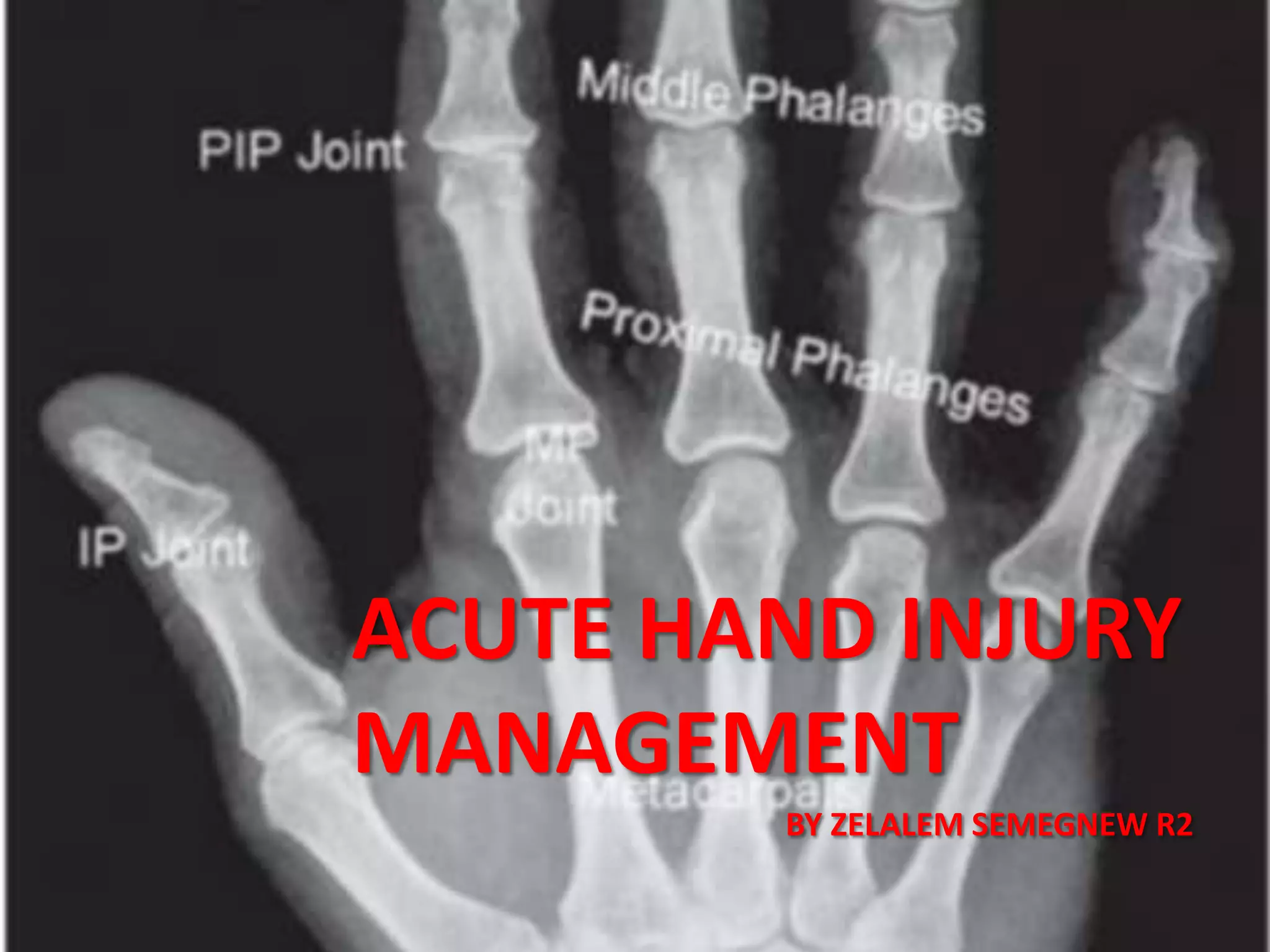 Acute hand injury management | PPTX
