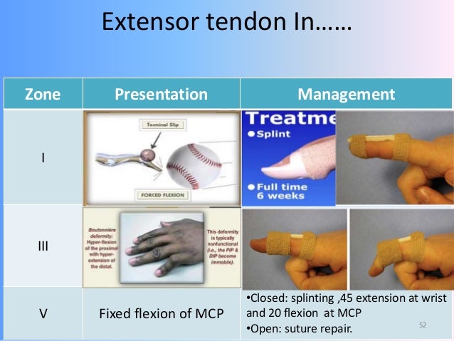 Acute hand injury management