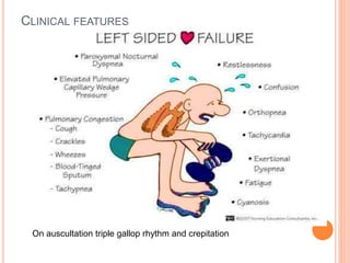 Acute heart failure | PPTX