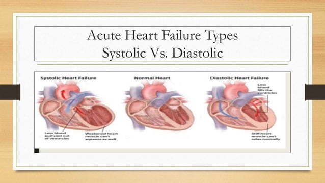 Acute Heart Failure presentation by Dr Chikondi Malobe | PPT