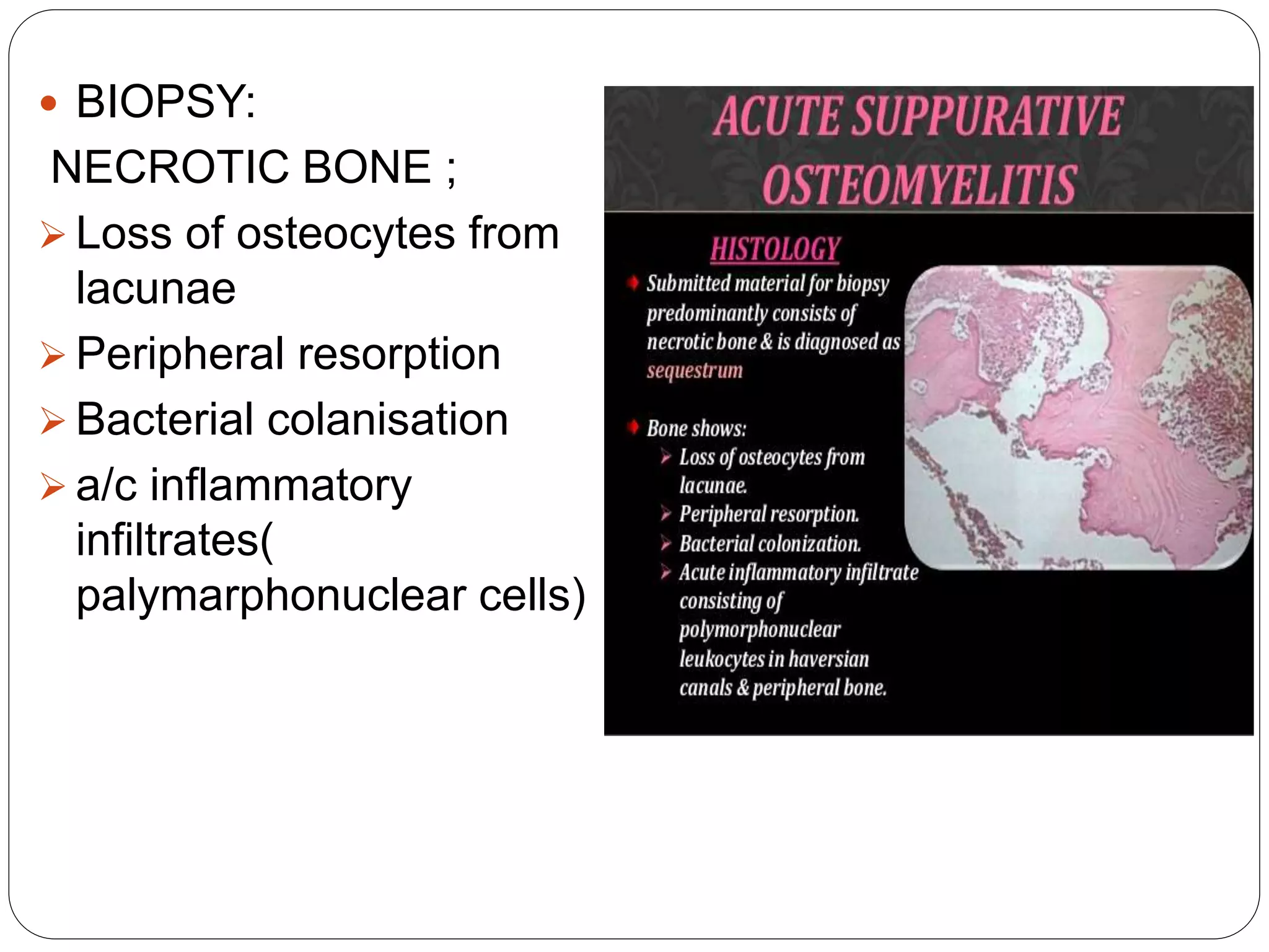 Acute hematogenous osteomyelitis | PPTX