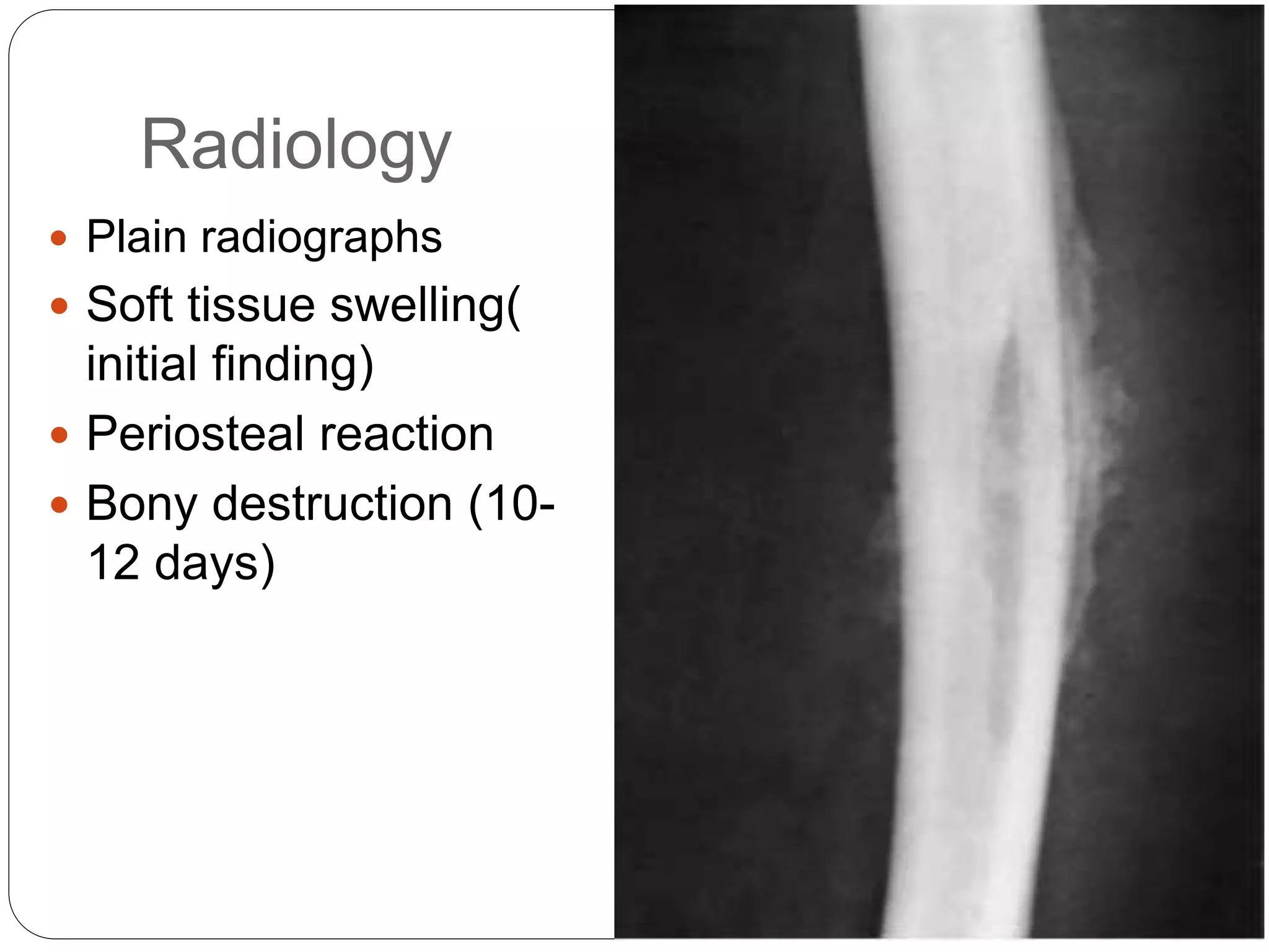Acute hematogenous osteomyelitis | PPTX