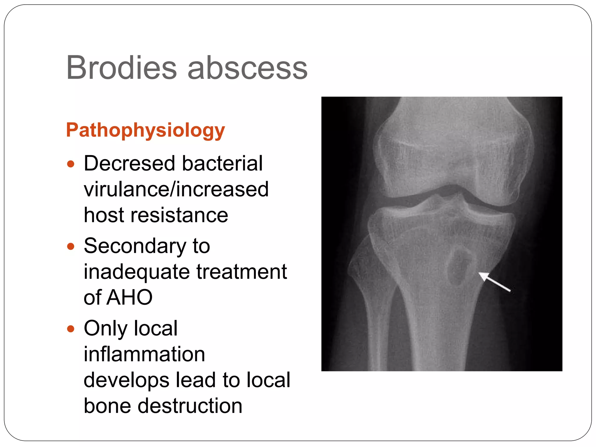 Acute hematogenous osteomyelitis | PPTX