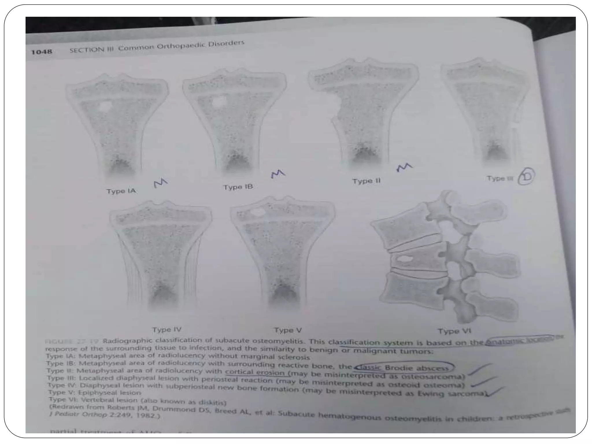 Acute hematogenous osteomyelitis | PPTX