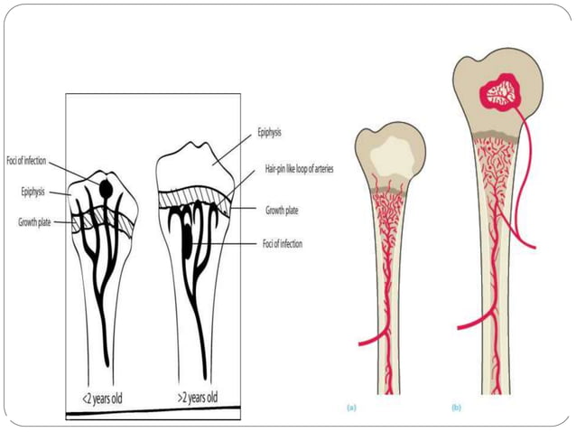 Acute hematogenous osteomyelitis | PPTX