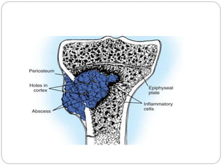 Acute hematogenous osteomyelitis | PPTX