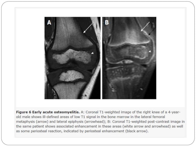Acute hematogenous osteomyelitis | PPTX