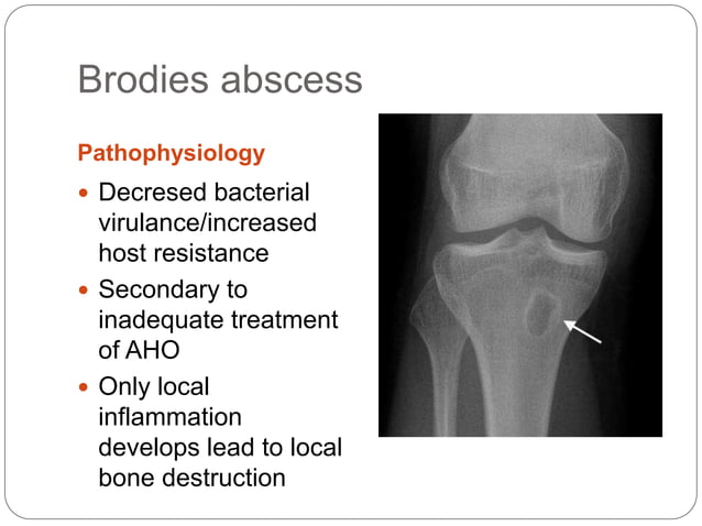 Acute hematogenous osteomyelitis | PPTX
