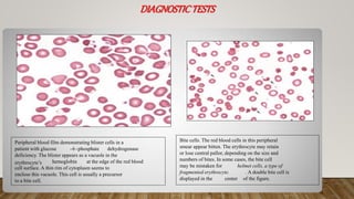 Acute hemolytic anemia | PPTX