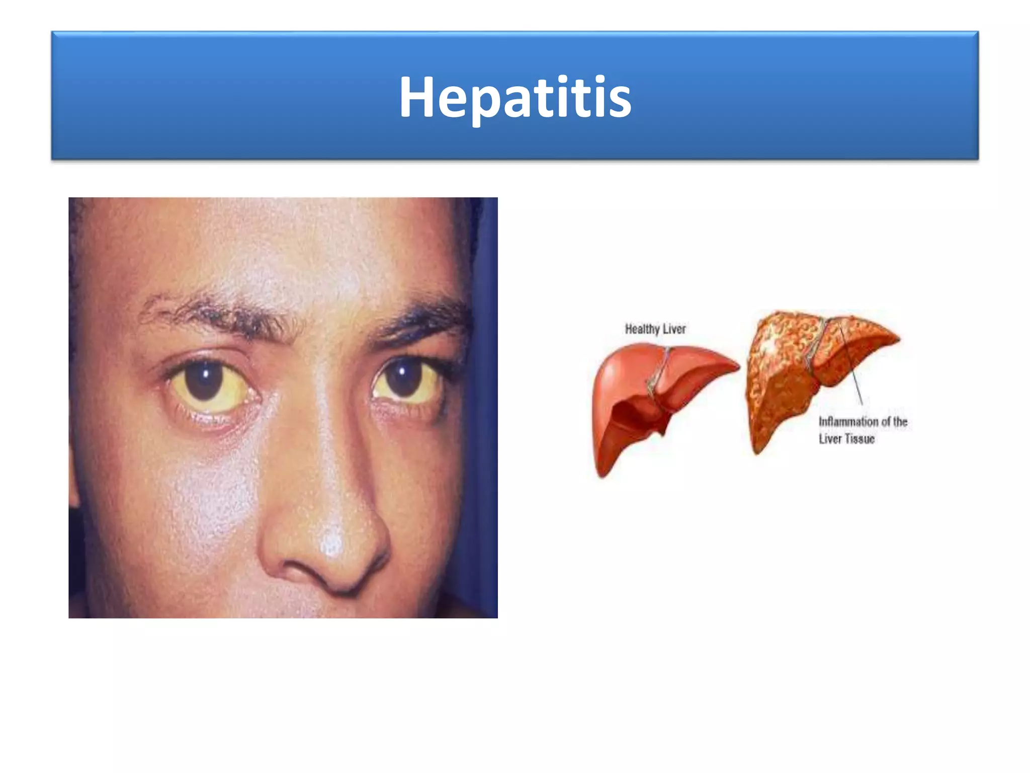 Acute hepatitis in pediatrics | PPTX