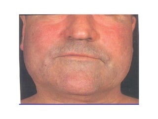 Acute hepatitis 2 | PPTX