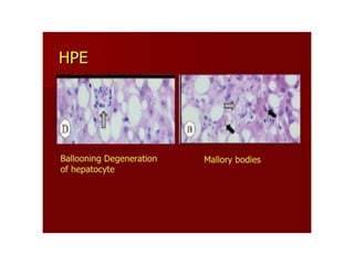 Acute hepatitis 2 | PPTX