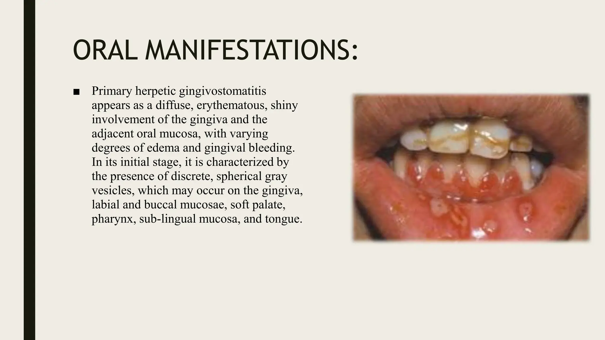 Acute herpetic gingivostomatitis (1).pptx