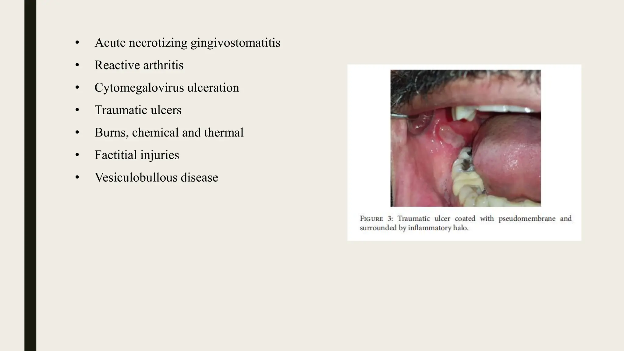Acute herpetic gingivostomatitis (1).pptx