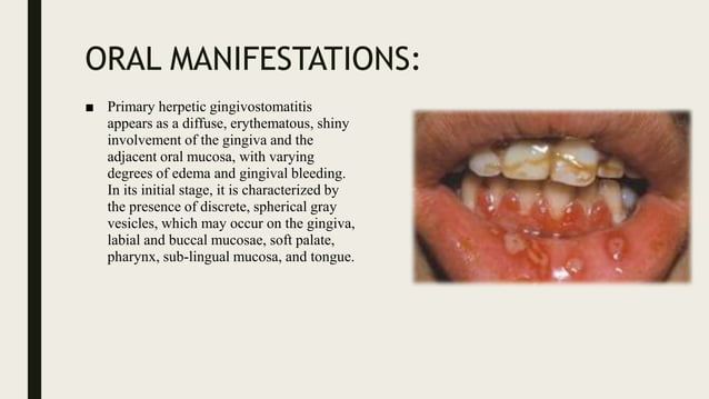 Acute herpetic gingivostomatitis (1).pptx