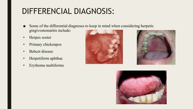 Acute herpetic gingivostomatitis (1).pptx
