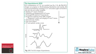 Acute Hyperkalemia Management - Dr. Gawad | PPTX