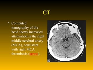 Acute infarction cerebral | PPT
