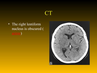 Acute infarction cerebral | PPT