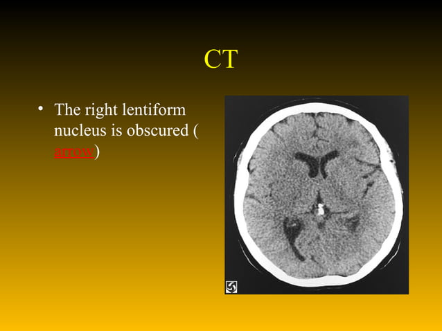 Acute infarction cerebral | PPT | Brain and Nervous System Disorders ...